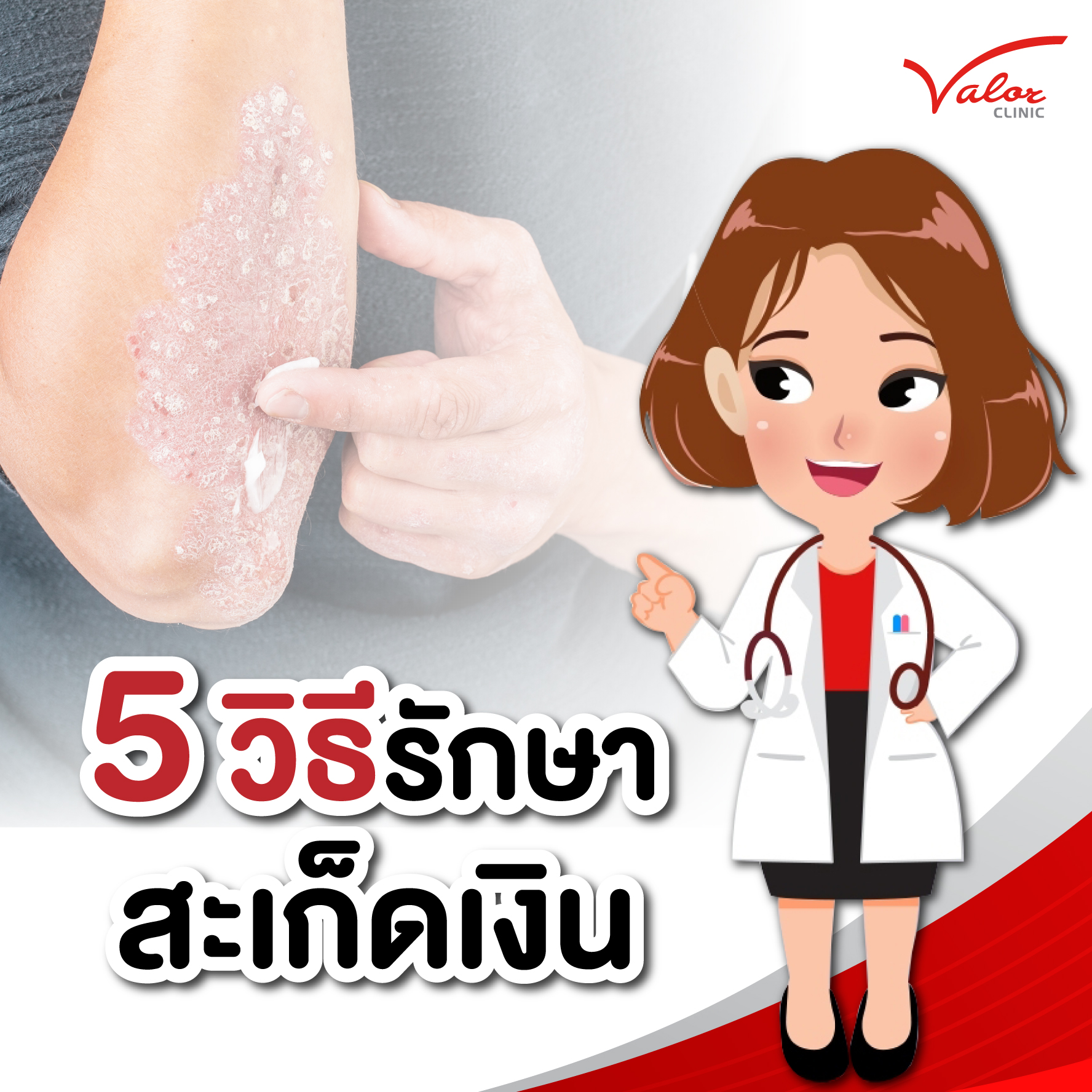 Unlocking the Path to Psoriasis Relief: 5 Effective Treatment ...