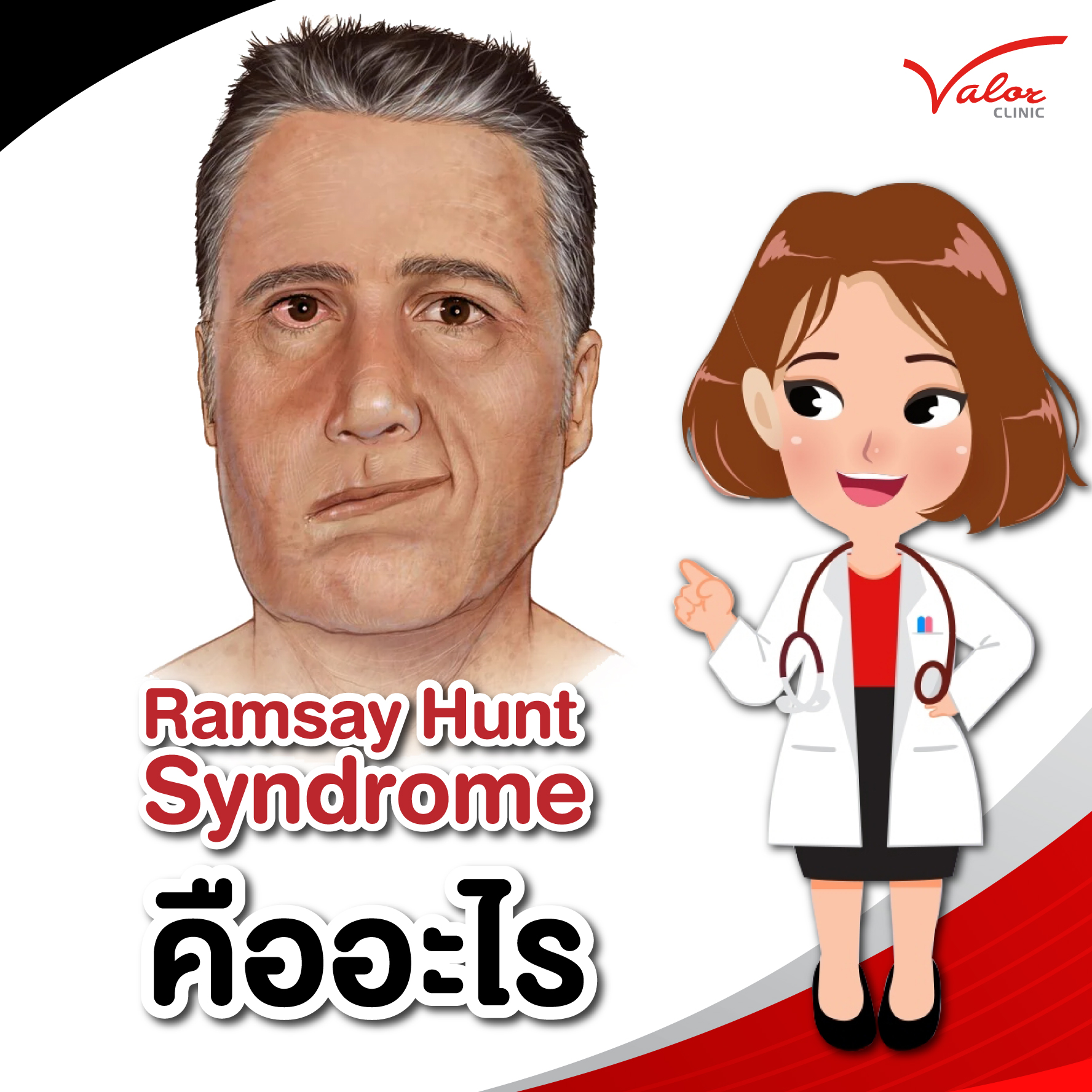 Demystifying Ramsay Hunt Syndrome: A Face-Afflicting Shingles - Valor ...